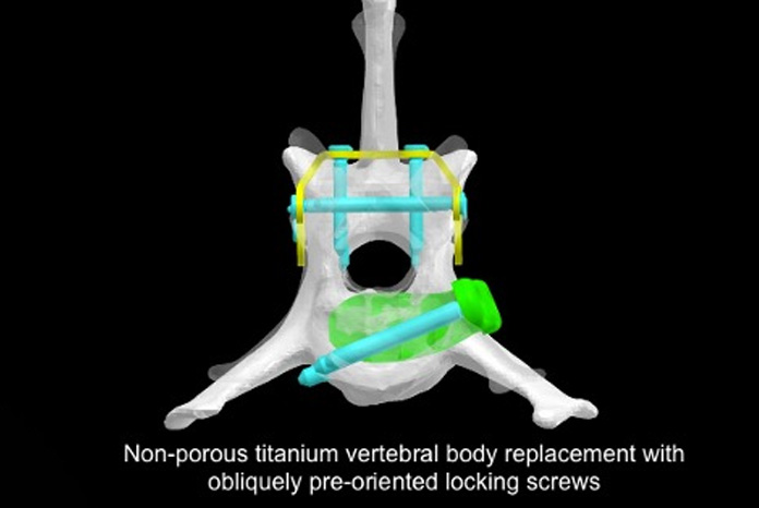UK-first procedure for dog with cancerous vertebra - VetSurgeon News ...