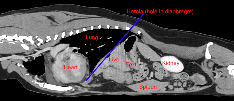 Congenital defect complicating a case of septic peritonitis in a ...