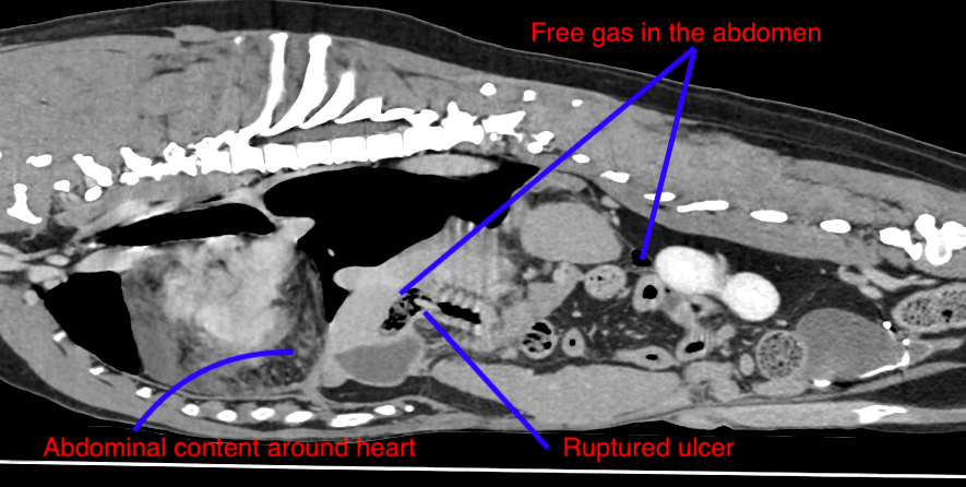 Congenital defect complicating a case of septic peritonitis in a ...